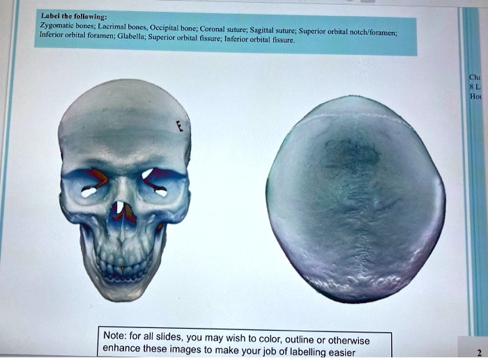 SOLVED: Zygomatic bones; Lacrimal bones; Occipital bone; Coronal suture ...
