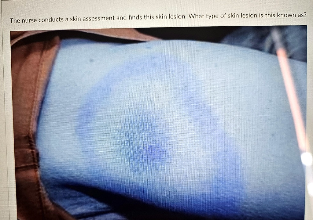 [GET ANSWER] the nurse conducts a skin assessment and finds this skin ...
