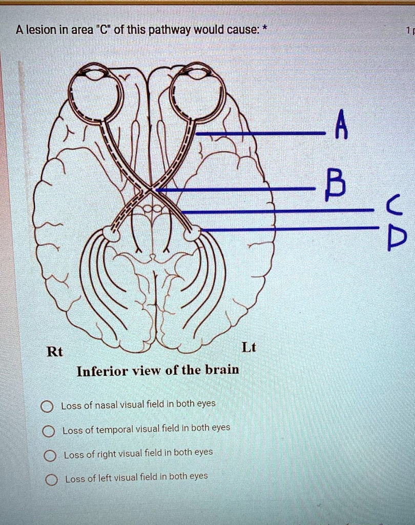 A lesion in area "C" of this pathway would cause: Rt Lt Inferior view ...