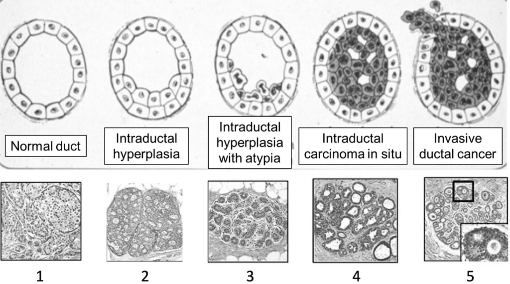 SOLVED: Intraductal hyperplasia with atypia Normal duct Intraductal ...
