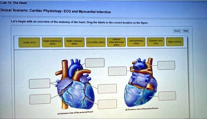 SOLVED: Lab 12: The Heart Clinical Scenario: Cardiac Physiology - ECG and Myocardial Infarction ...