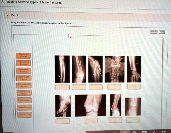 Art-labeling Activity: Types of bone fractures Part A Drag the labels ...