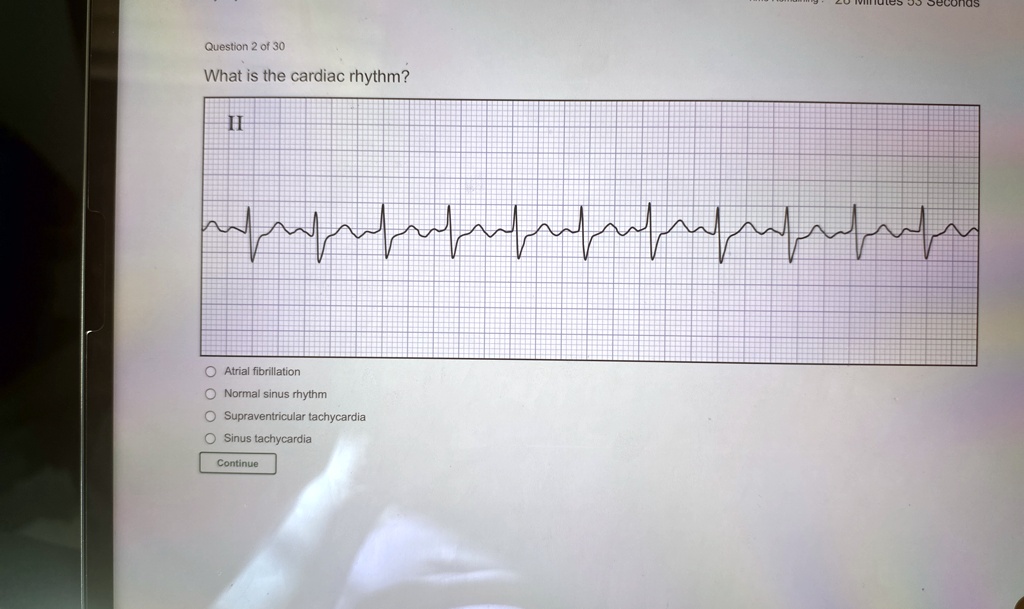 question 2 of 30 what is the cardiac rhythm ii atrial fibrillation ...
