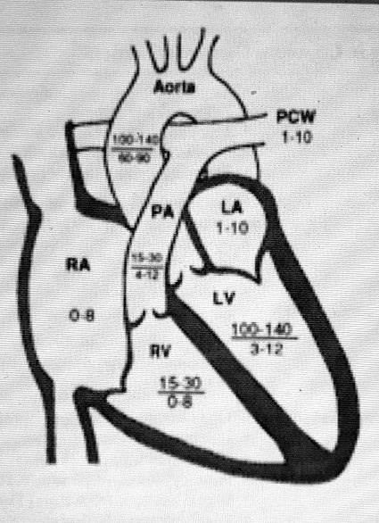 How do I calculate the systemic vascular resistance (SVR), peripheral ...