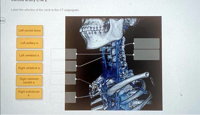 SOLVED: Texts: 6:23 Label the arteries of the neck in the CT angiogram ...