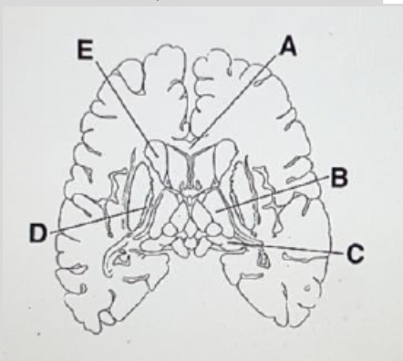 a 39 year old woman has had rapid twitching flicking movements of many ...
