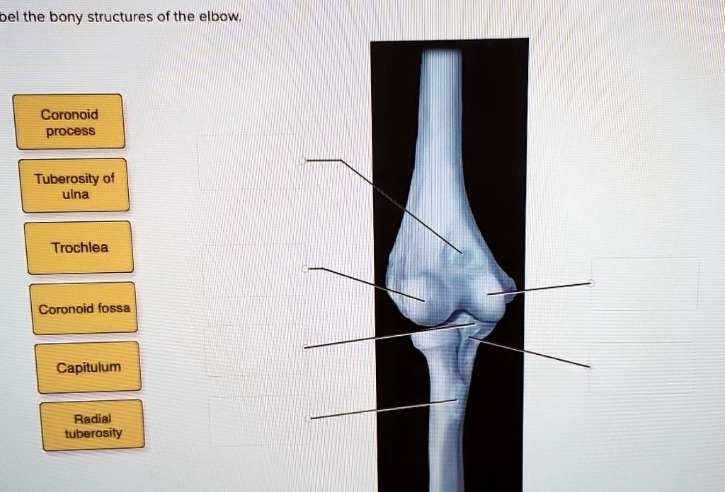 label the bony structures of the elbow coronoid process tuberosity of ulna trochlea coronoid ...
