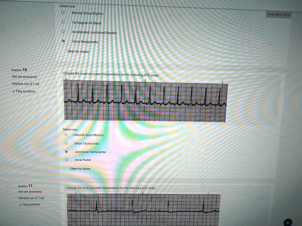 SOLVED: Normal Sinus Rhythm Sinus Bradycardia Ventricular Tachycardia ...