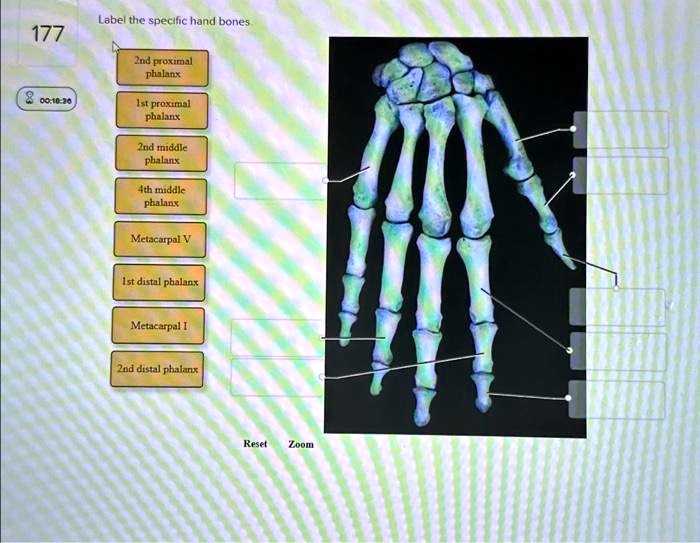 177 00:10:36 Label the specific hand bones. 2nd proximal phalanx 1st ...