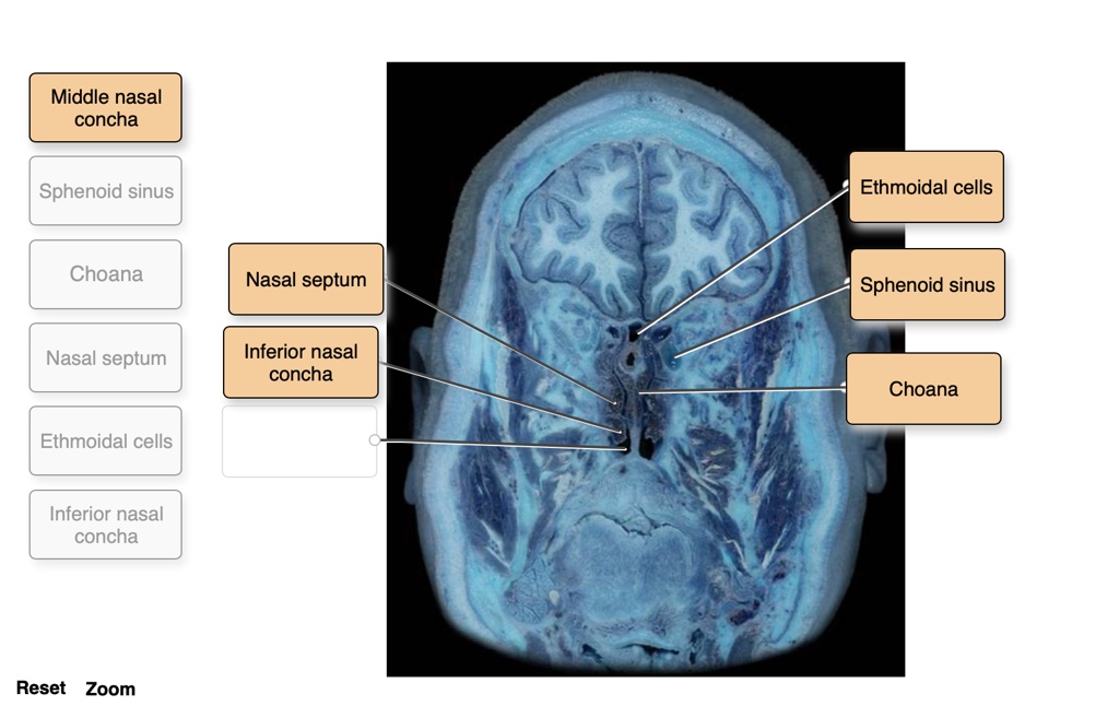 SOLVED: Nasal septum Nasal septum Inferior nasal concha Inferior nasal ...
