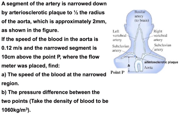 A segment of the artery is narrowed down by arteriosclerotic plaque to ...