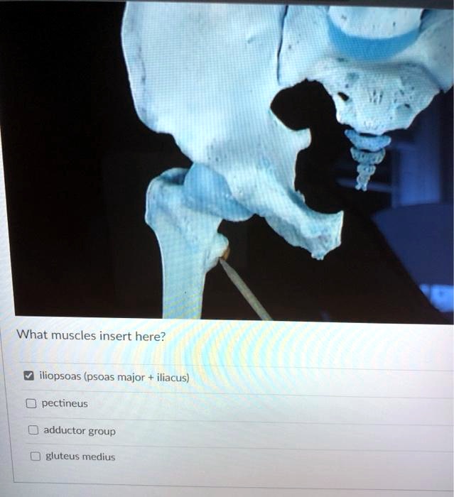 What muscles insert at the lesser trochanter of the femur? iliopsoas ...