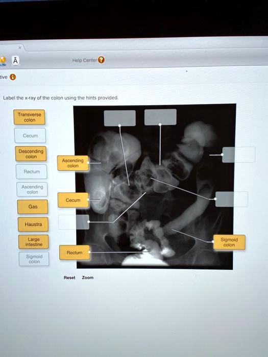 Label the x-ray of the colon using the hints provided. Transverse colon ...