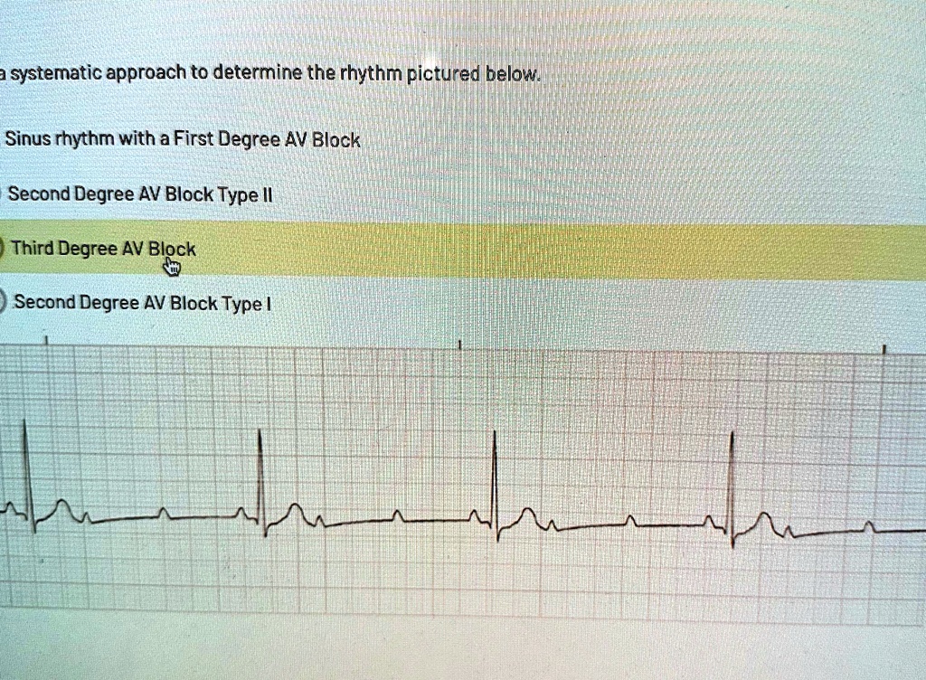 Use a systematic approach to determine the rhythm pictured below. Sinus rhythm with a First ...