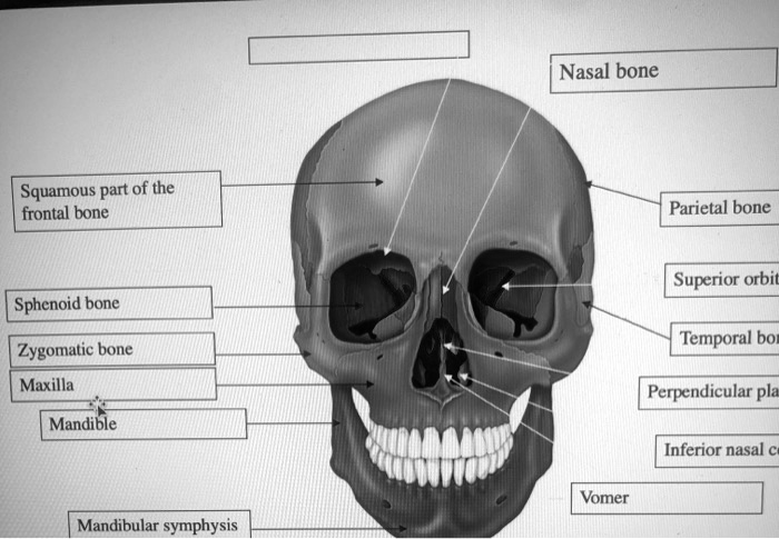 SOLVED: Nasal bone Squamous part of the frontal bone Parietal bone ...