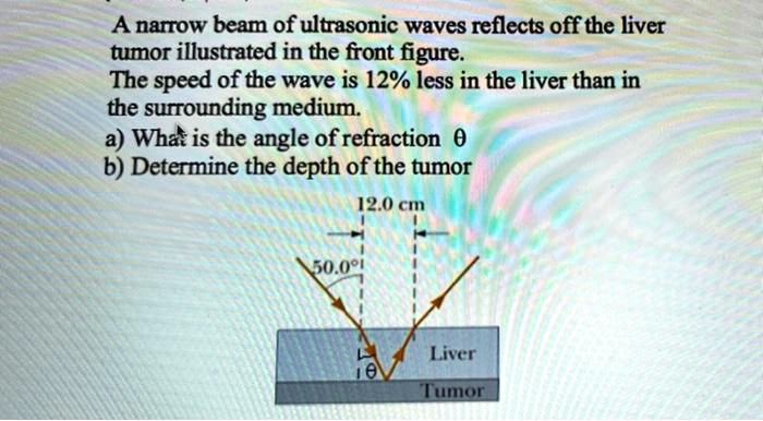 A narrow beam of ultrasonic waves reflects off the liver tumor ...