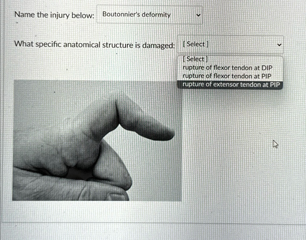 Name the injury below: Boutonnier's deformity What specific anatomical ...