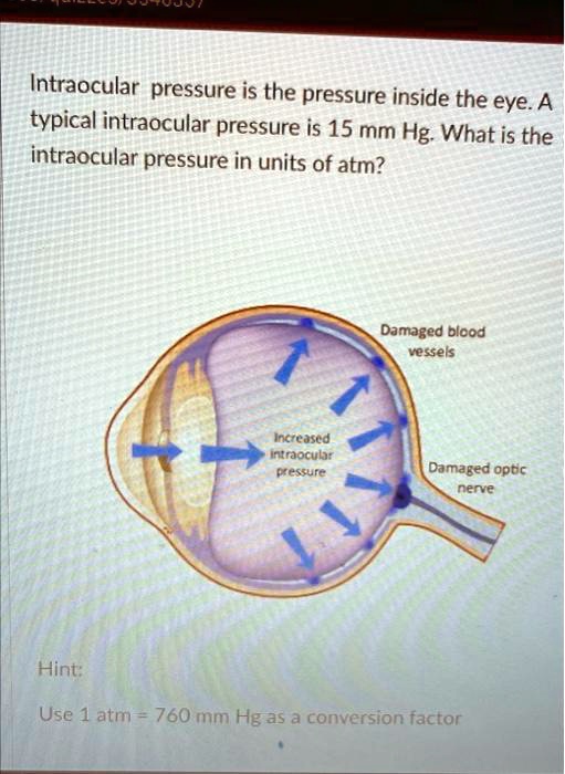 Intraocular pressure is the pressure inside the eye. A typical ...