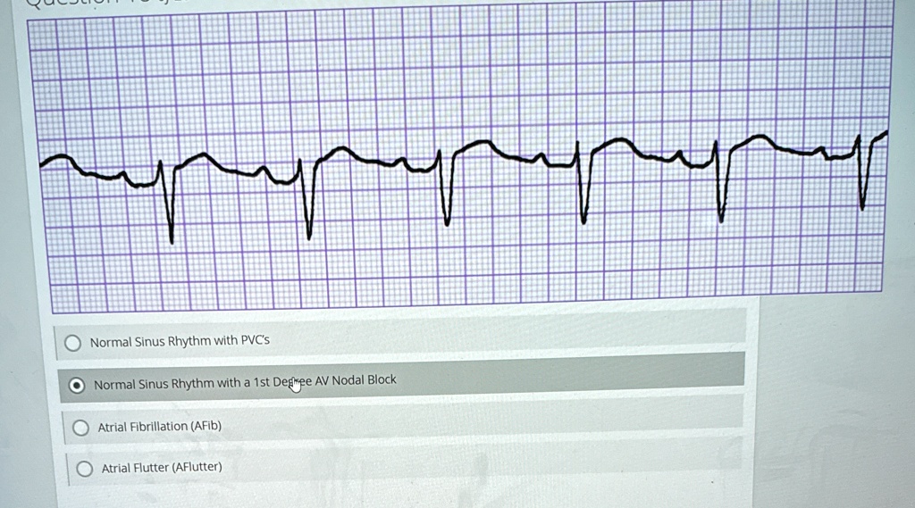 Normal sinus rhythm with pvcs normal sinus rhythm with a 1st...