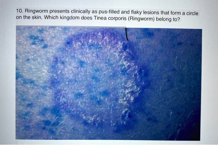 10 ringworm presents clinically as pus filled and flaky lesions that ...