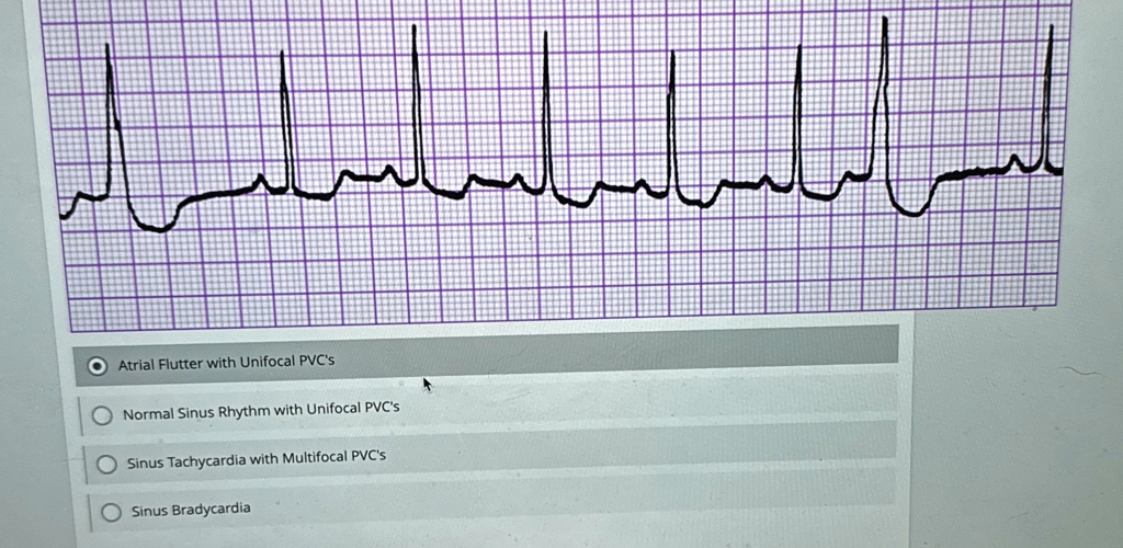 atrial flutter with unifocal pvcs normal sinus rhythm with unifocal ...