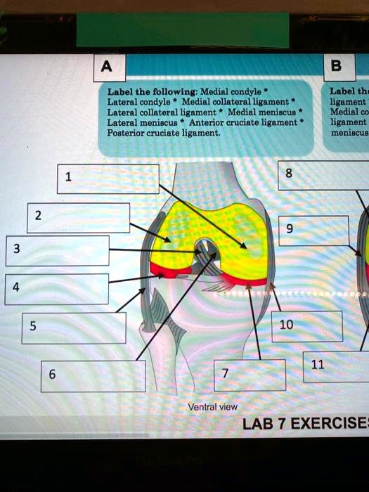 A Label the following: Medial condyle * Lateral condyle * Medial ...
