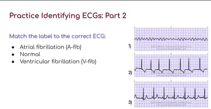 SOLVED: Practice Identifying ECGs: Part 2 Match the label to the correct ECG Atrial fibrillation ...