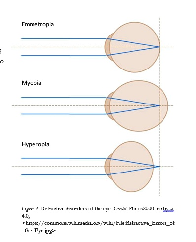 VIDEO solution: Look closely at the diagram of an eye with normal ...