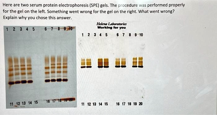 SOLVED: Here are two serum protein electrophoresis (SPE) gels. The ...