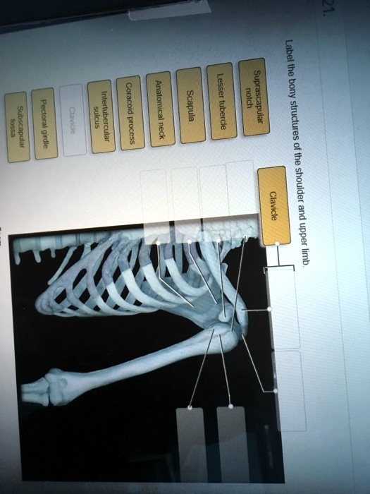 Sulcus Intertubercular Coracoid Process Anatomical Neck Scapula Lesser Tubercle Notch