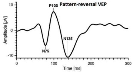 SOLVED: A typical pattern-reversal VEP is shown in the figure. Draw the ...