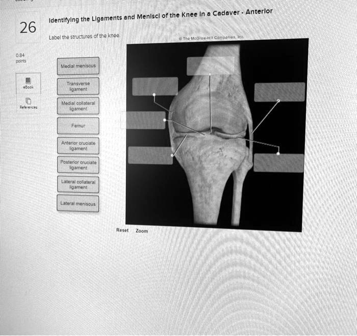 Identifying the Ligaments and Menisci of the Knee in a Cadaver - Anterior 26 Label the ...
