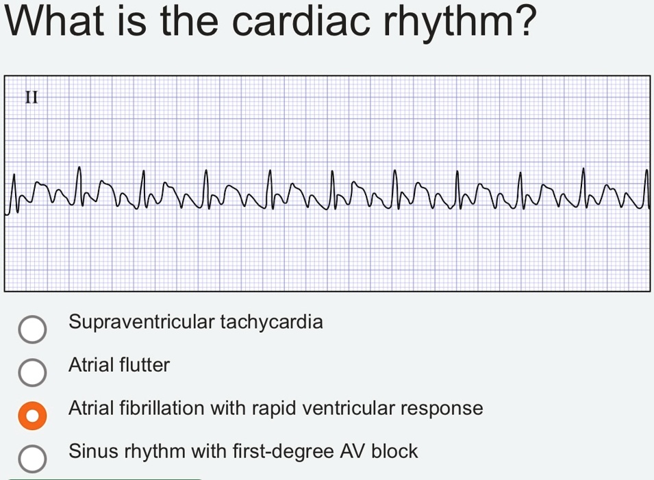 what is the cardiac rhythm shown in the ekg strip please choose from ...