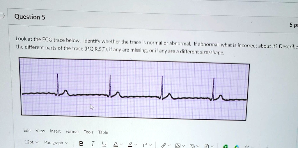 Question 5 5 pt Look at the ECG trace below. Identify whether the trace ...