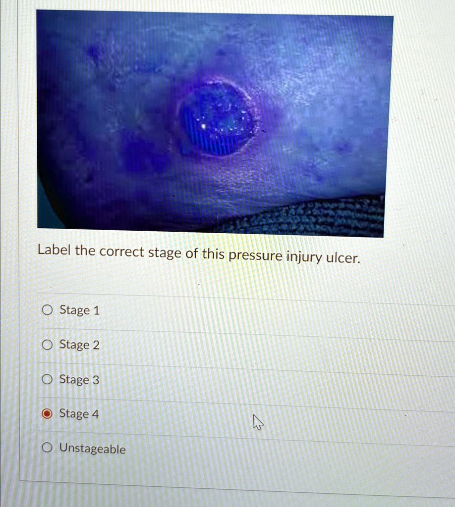 label the correct stage of this pressure injury ulcer stage 1 stage 2 ...