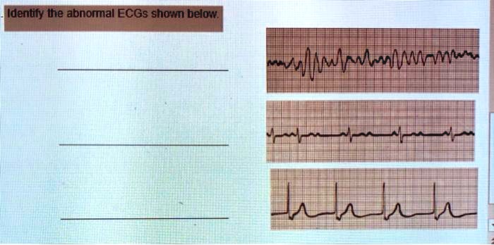 SOLVED: Identify the abnormal ECGs shown below