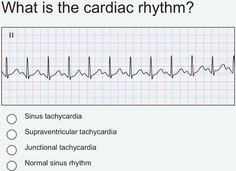 From the Multiple choice options provided below the EKG strip, What ...