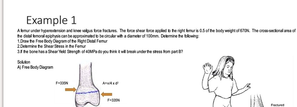 Example 1 A femur under hyperextension and knee valgus force fractures ...