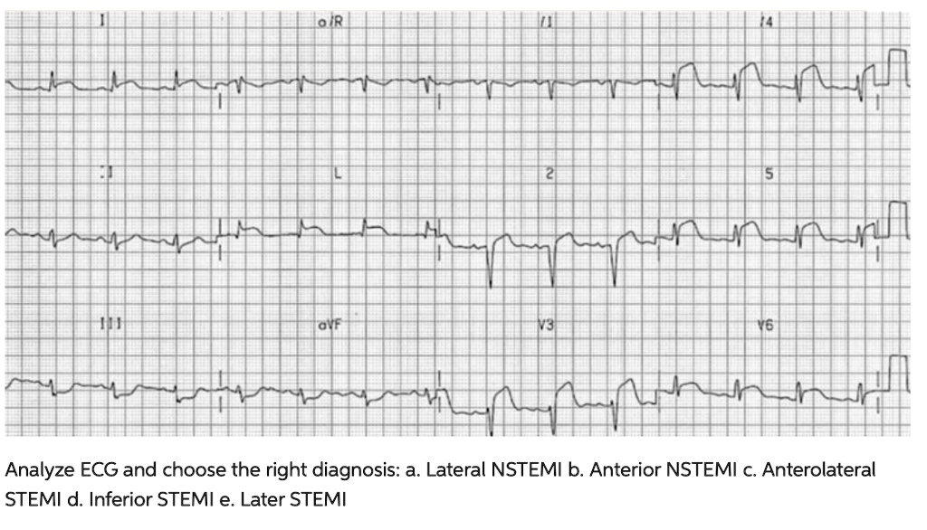 SOLVED: Text: Analyze ECG and choose the right diagnosis: a. Lateral NSTEMI b. Anterior NSTEMI c ...