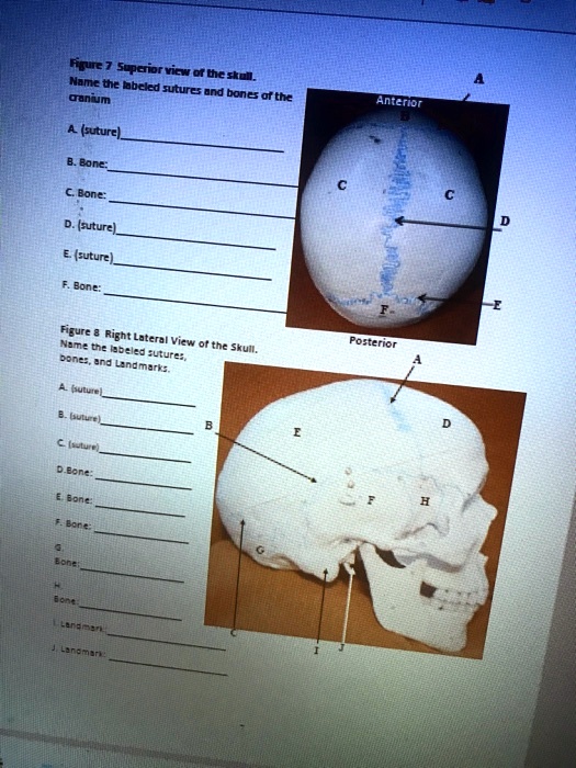 Figure 7 Superior view of the skull. Name the labeled sutures and bones ...