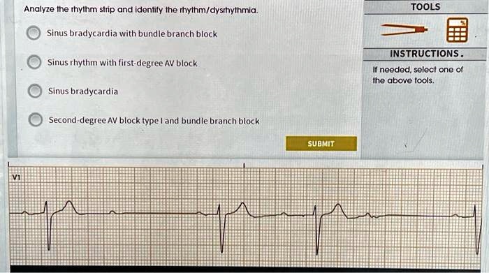 V1 Analyze the rhythm strip and identify the rhythm/dysrhythmia. Sinus ...