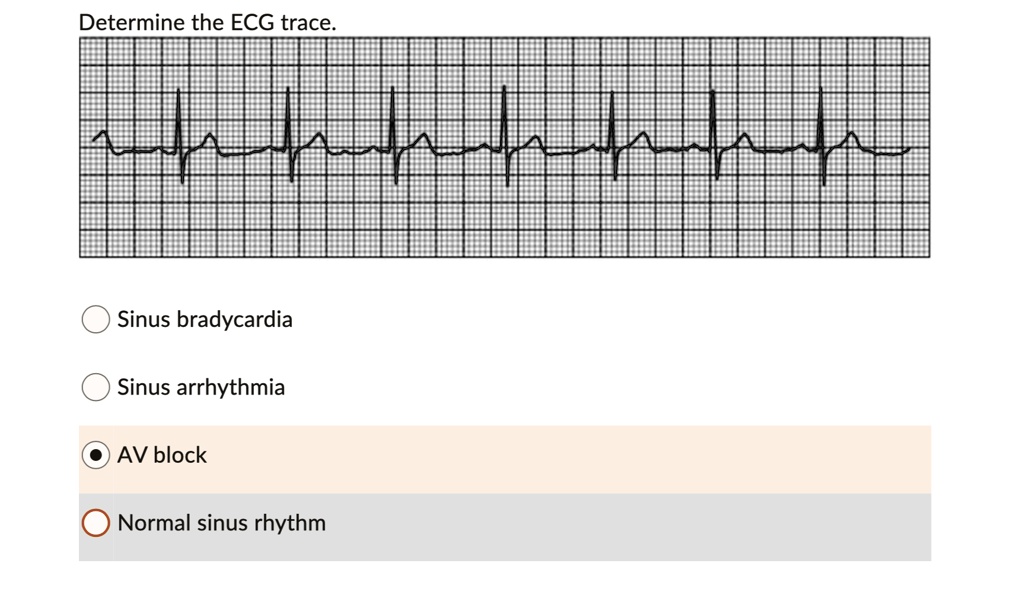 Determine the ECG trace Sinus bradycardia Sinus arrhythmia AV block ...