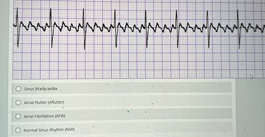 sinus bradycardia atrial flutter aflutter atrial fibrillation afib ...