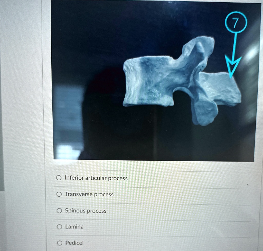Inferior articular process Transverse process Spinous process Lamina ...