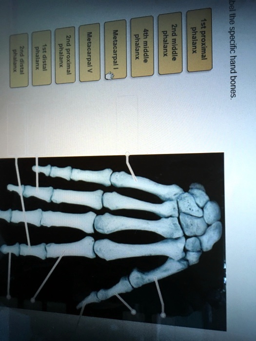 abel the specific hand bones. 1st proximal phalanx 2nd middle phalanx ...