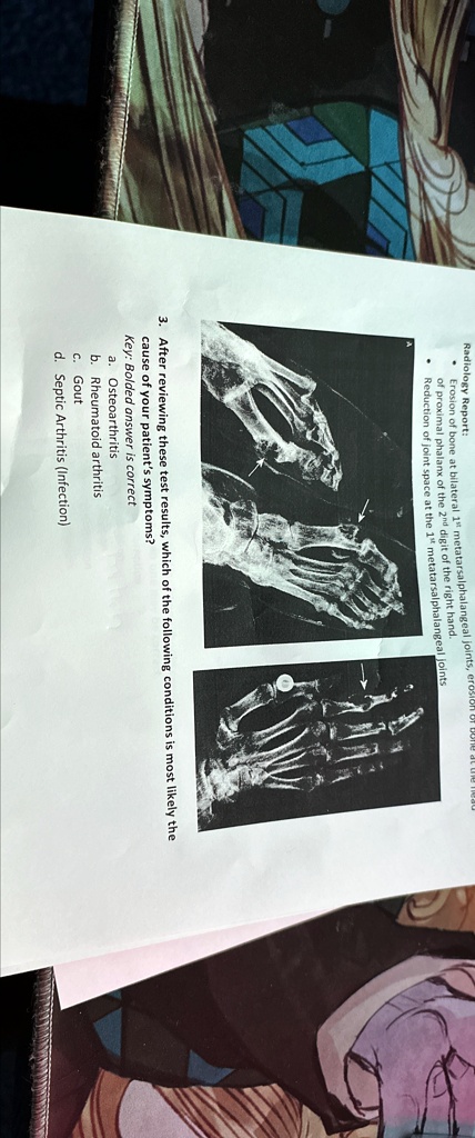 radiology report erosion of bone at bilateral 1st metatarsophalangeal ...