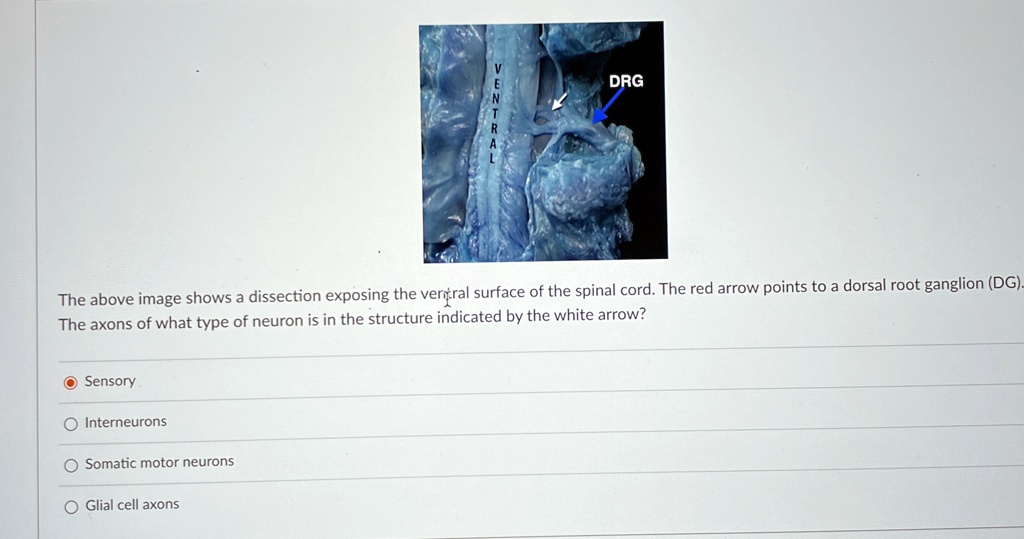 VENTRAL DRG The above image shows a dissection exposing the vertral ...