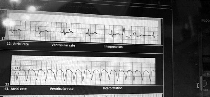 12 12. Atrial rate Ventricular rate Interpretation 13 13. Atrial rate ...