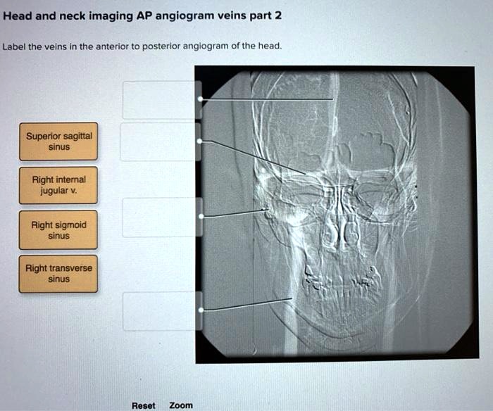 Label the veins in the anterior to posterior angiogram of the head ...
