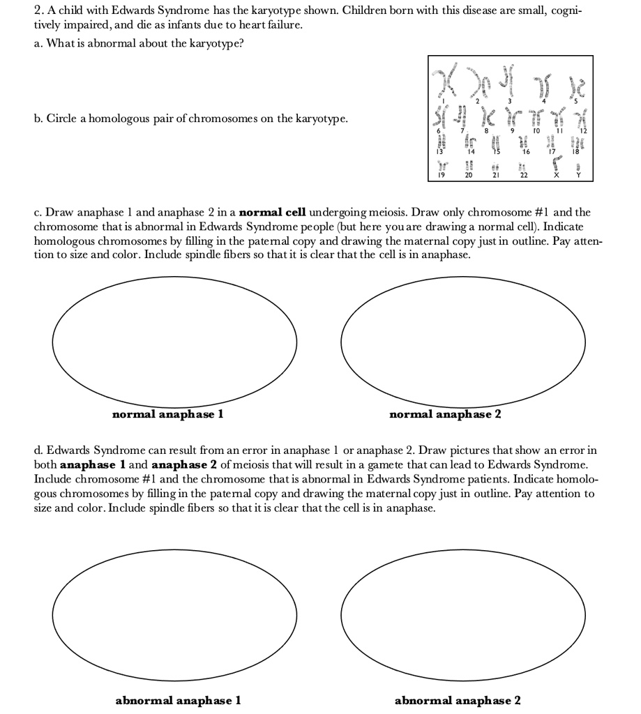 a child with edwards syndrome has the karyotype shown children born ...